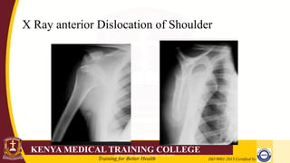 DISLOCATION OF THE SHOULDER.pptx well explained | PPTX