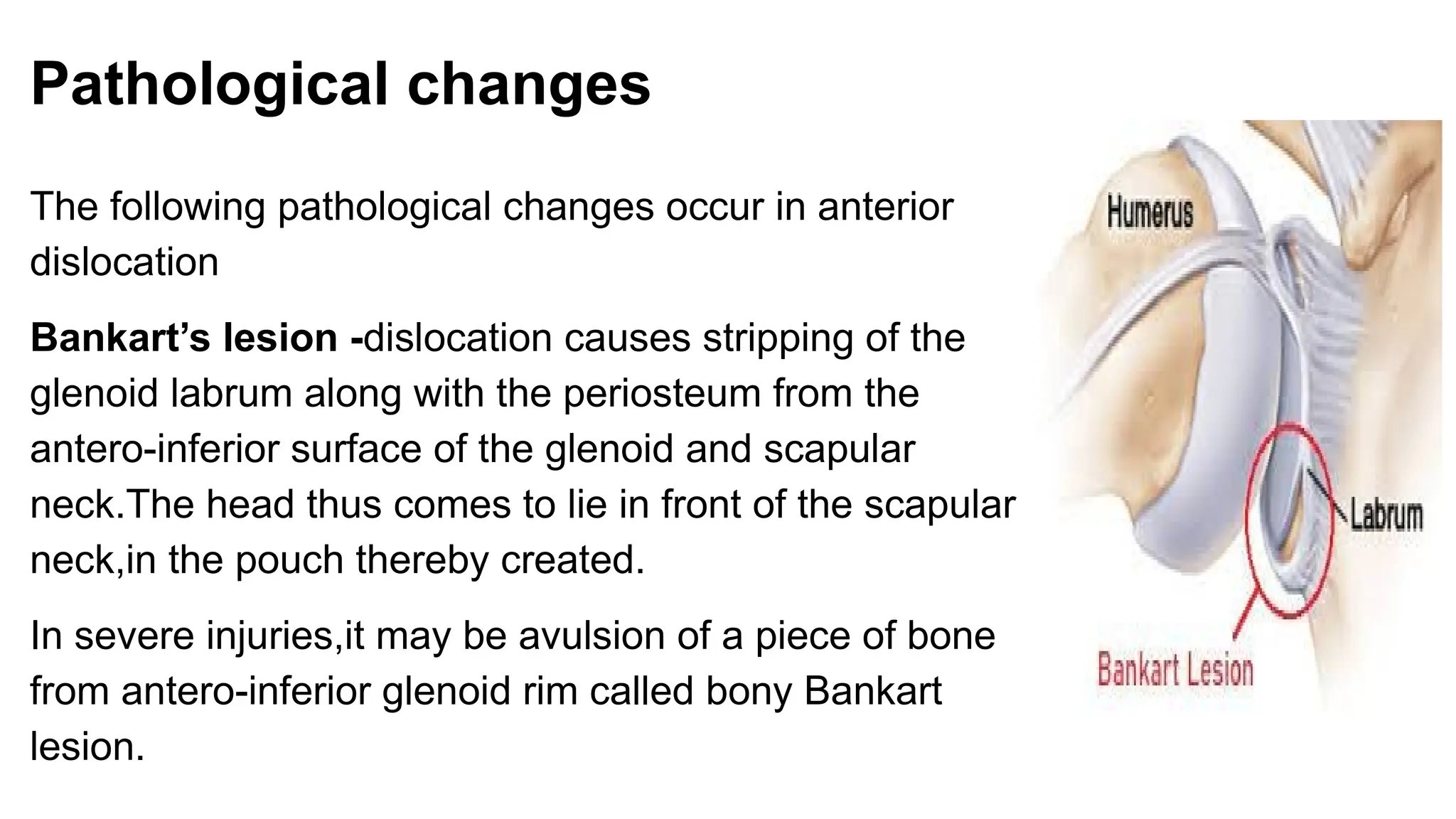 Dislocation of the shoulder mechanism and pathoanatomy | PPTX