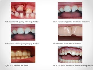 dislocations and fractures of the teeth.pdf