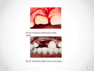dislocations and fractures of the teeth.pdf