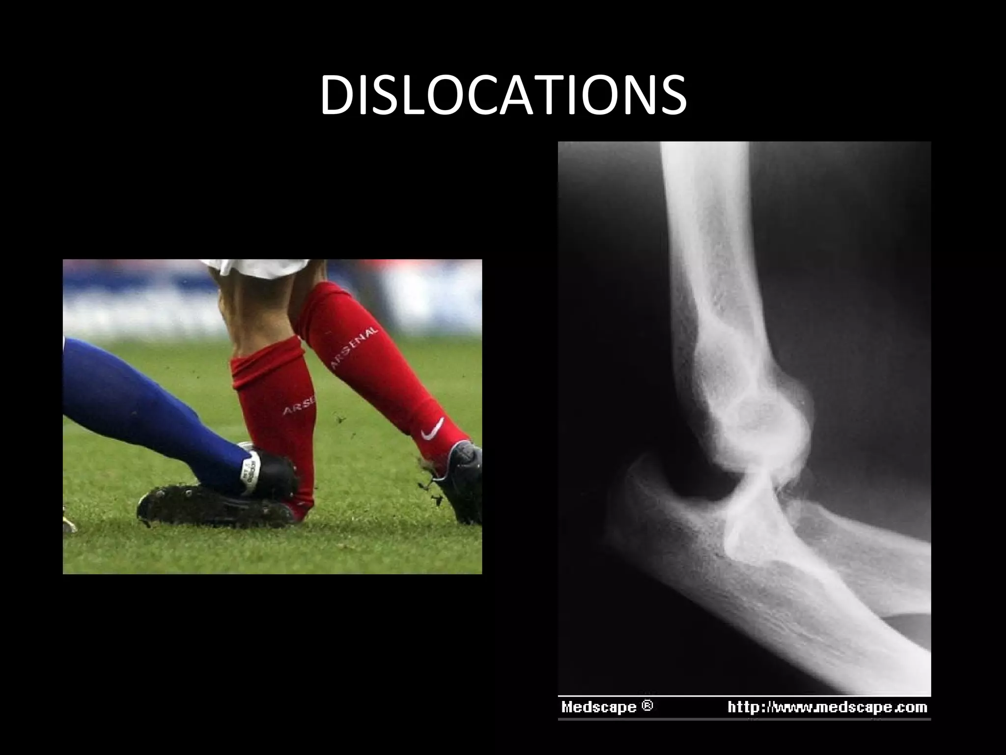 Dislocations | PPT