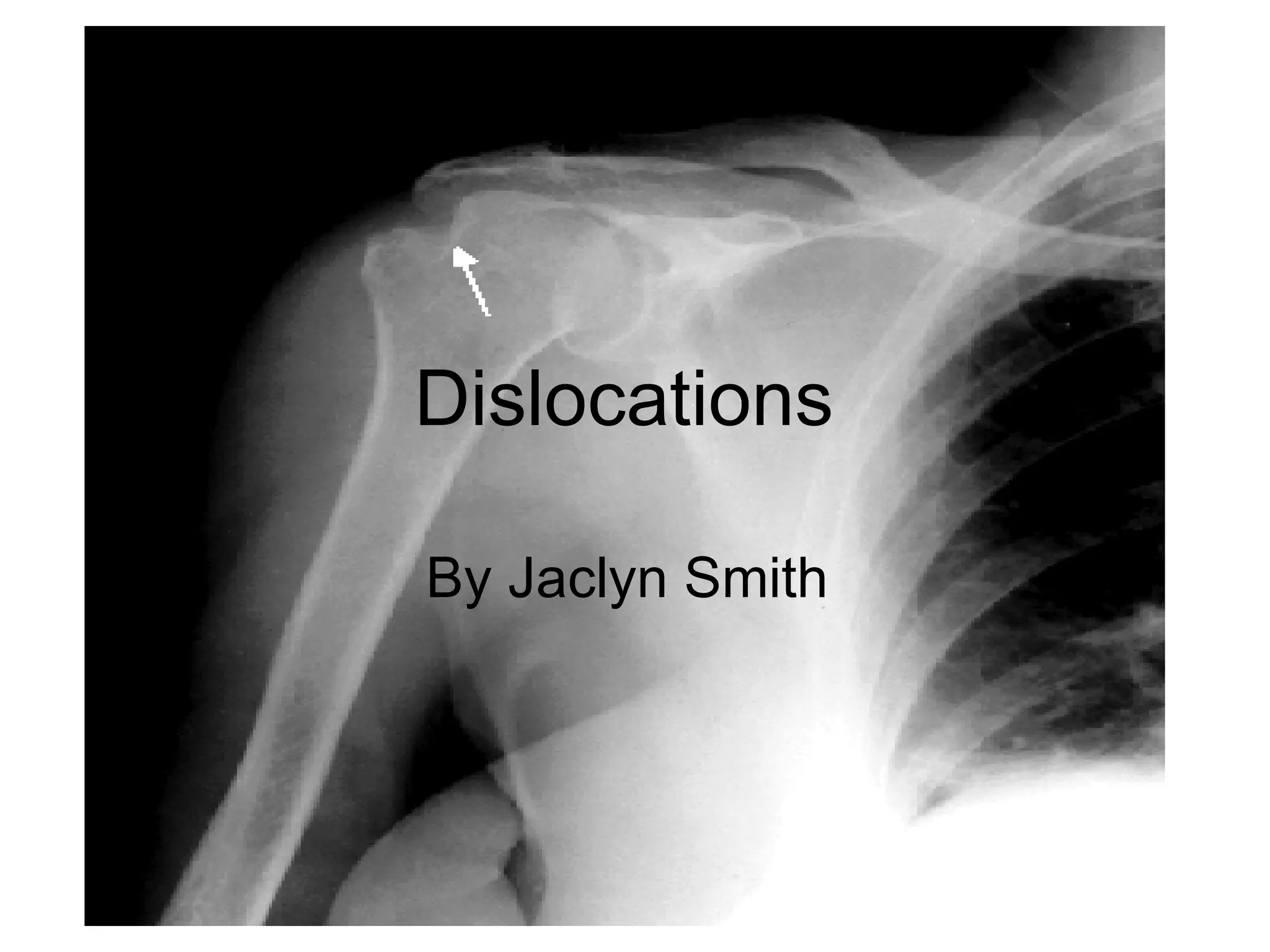 Dislocations | PPT