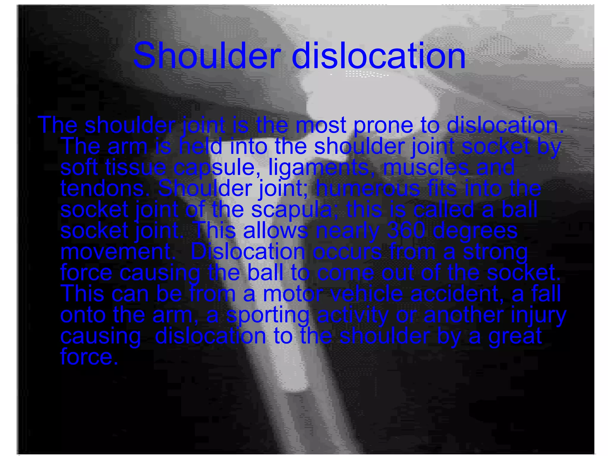 Dislocations | PPT