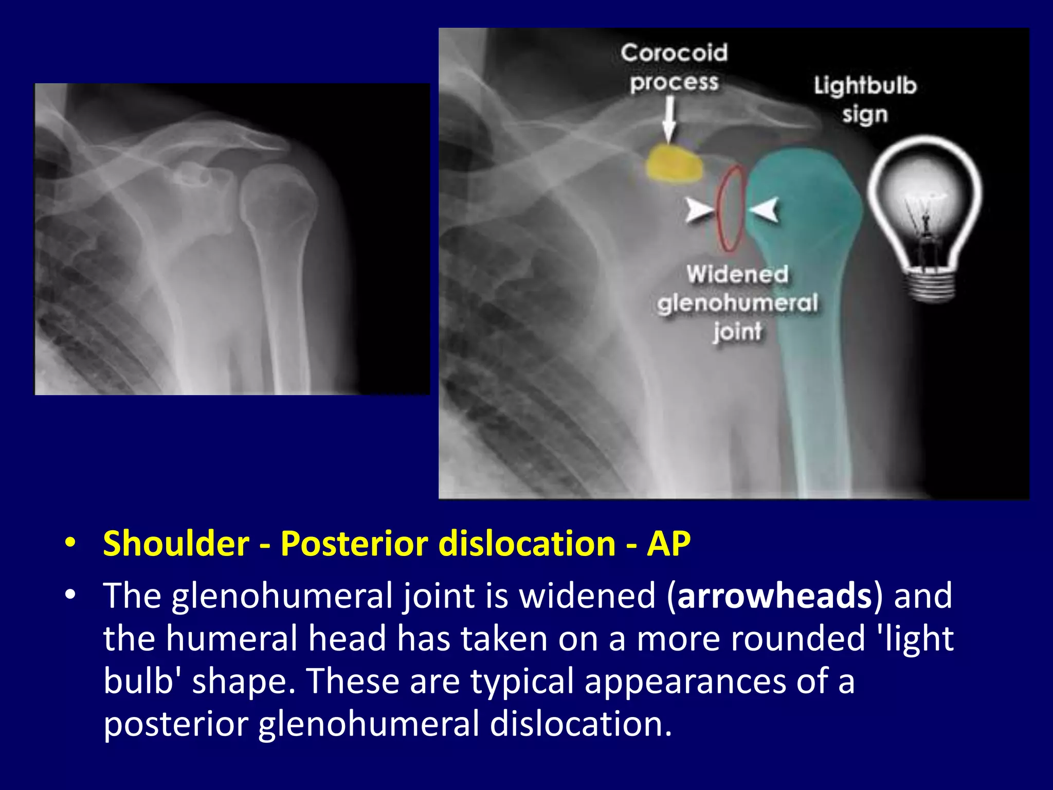 Dislocations of joint. Joint Dislocation | PPTX