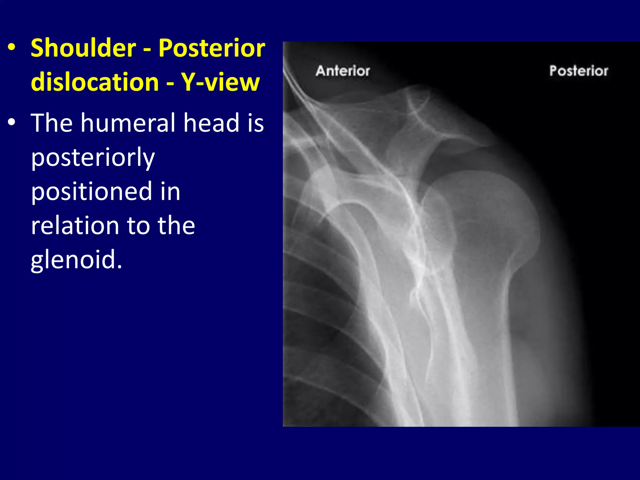 Dislocations of joint. Joint Dislocation | PPTX