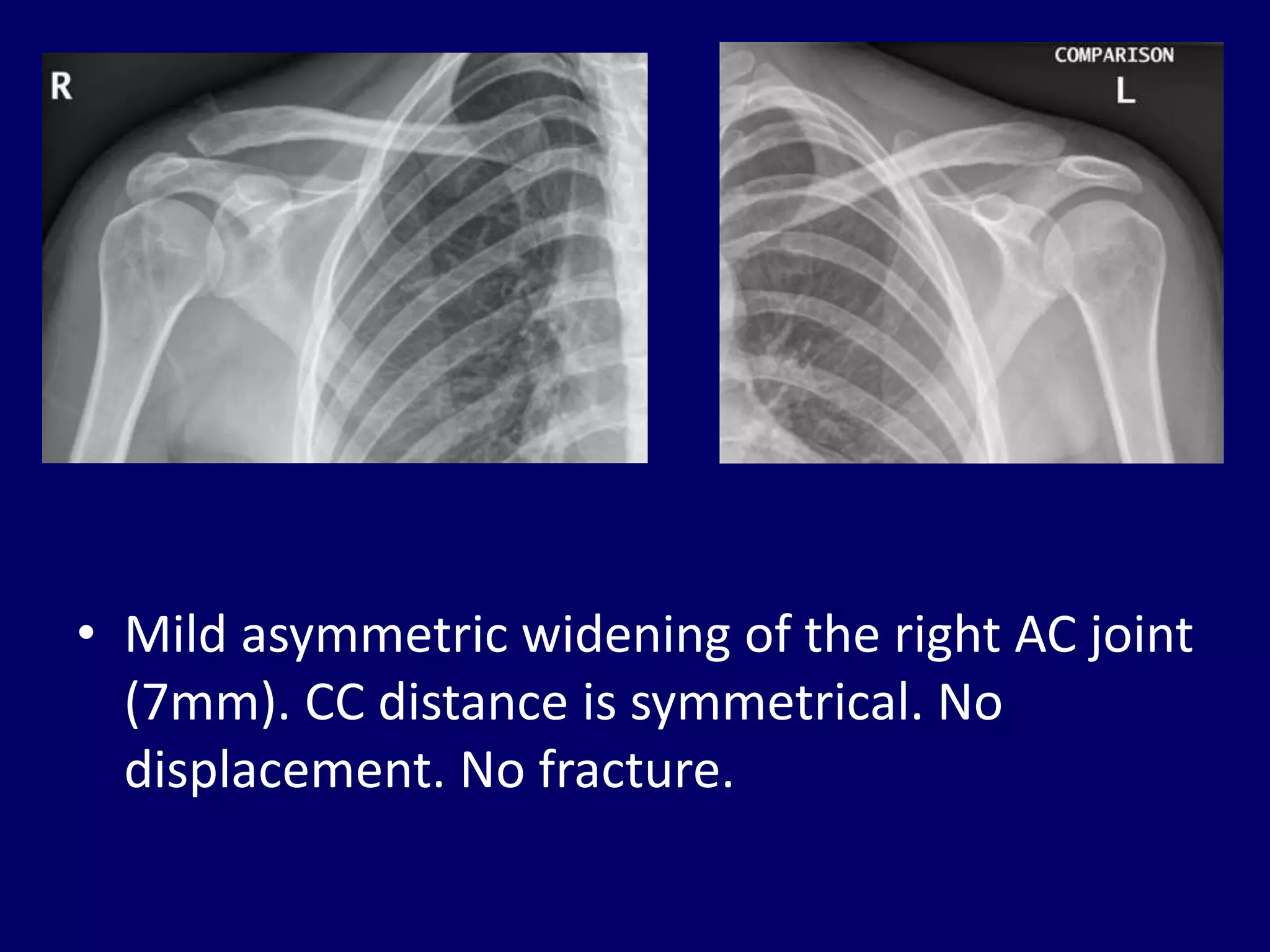 Dislocations of joint. Joint Dislocation | PPTX