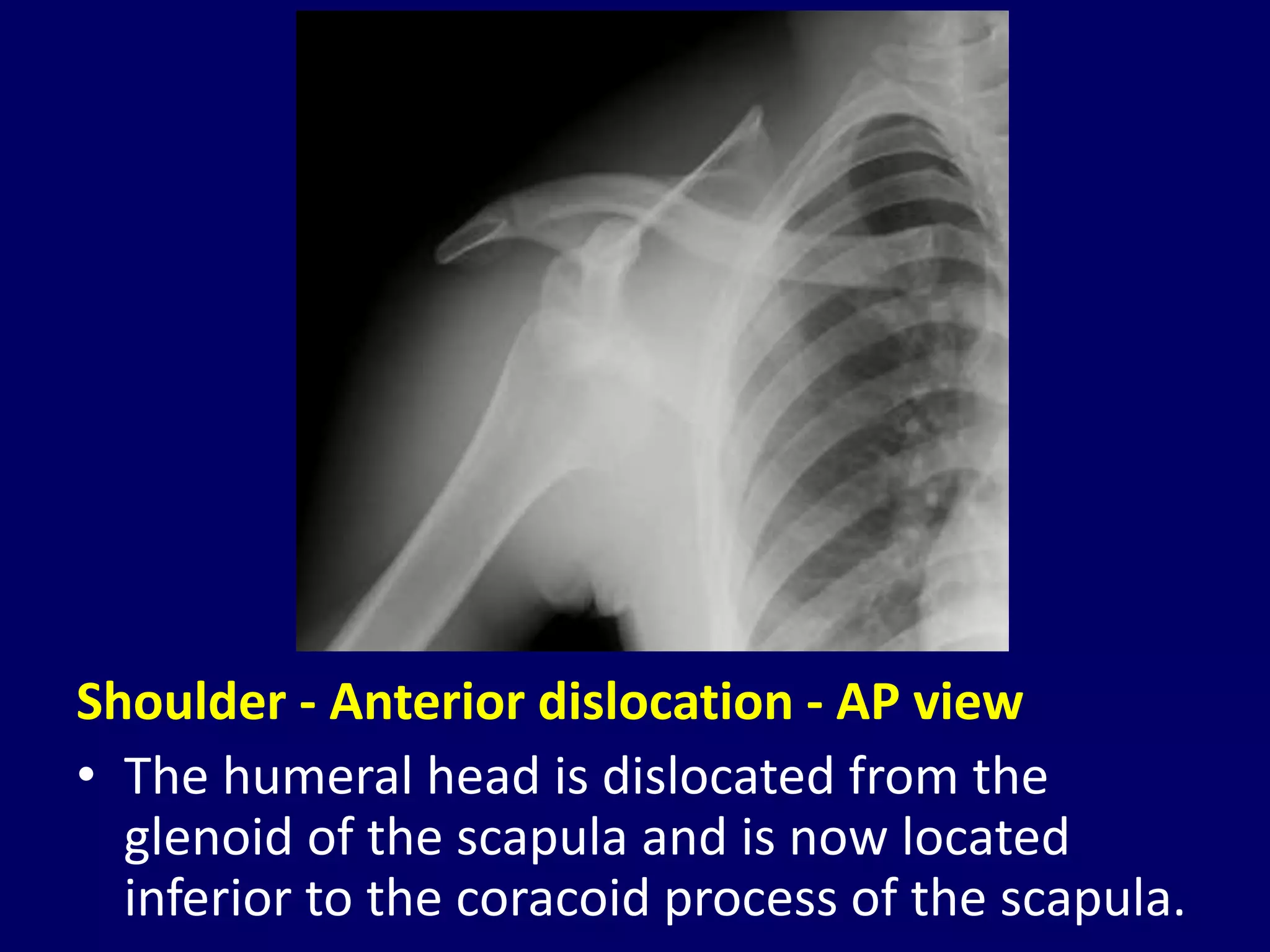 Dislocations of joint. Joint Dislocation | PPTX