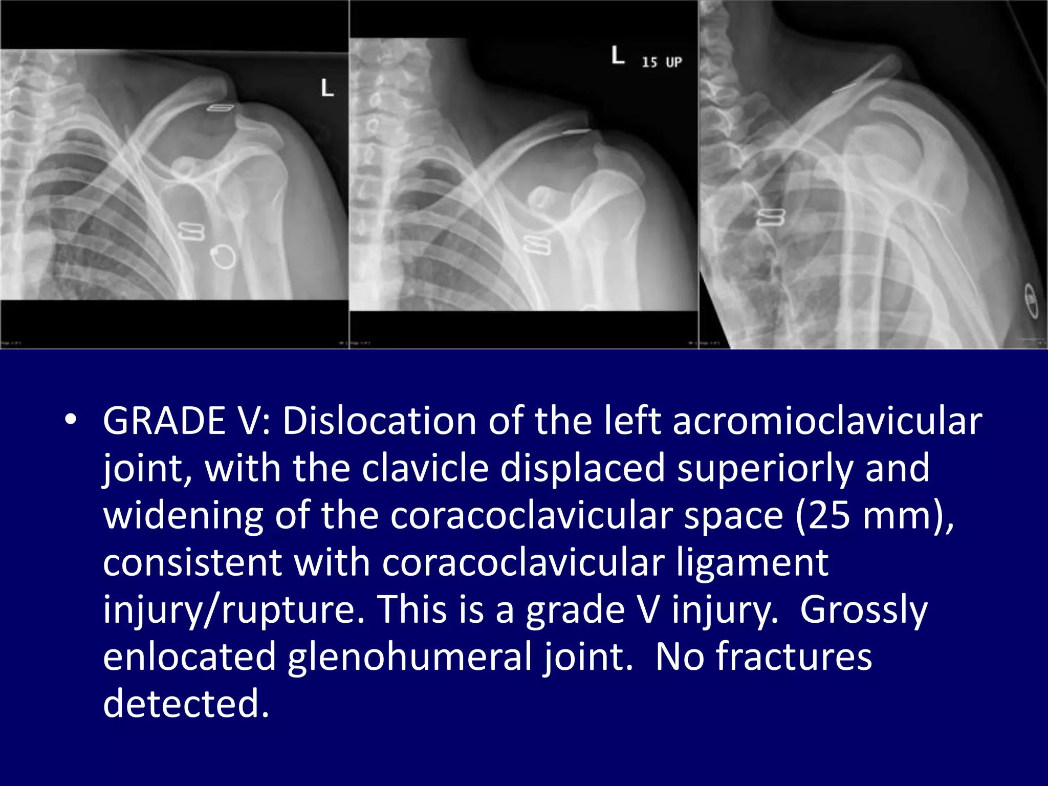 Dislocations of joint. Joint Dislocation | PPTX