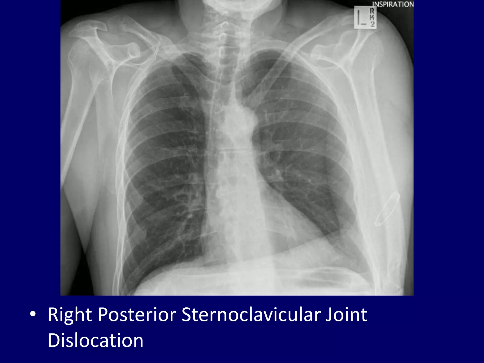 Dislocations of joint. Joint Dislocation | PPTX