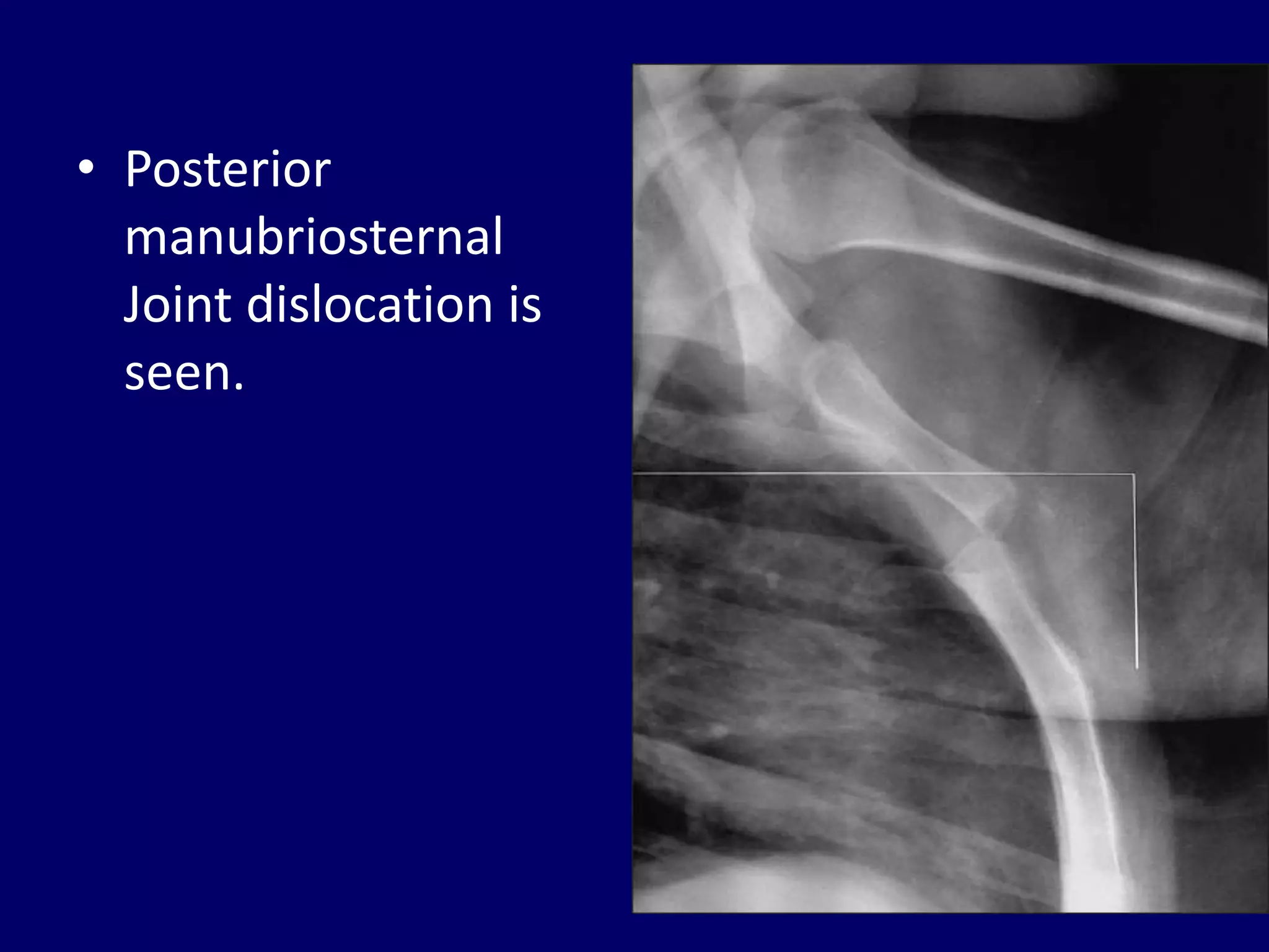 Dislocations of joint. Joint Dislocation | PPTX