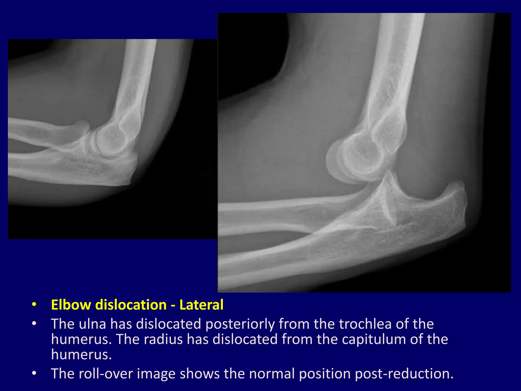 Dislocations of joint. Joint Dislocation | PPTX