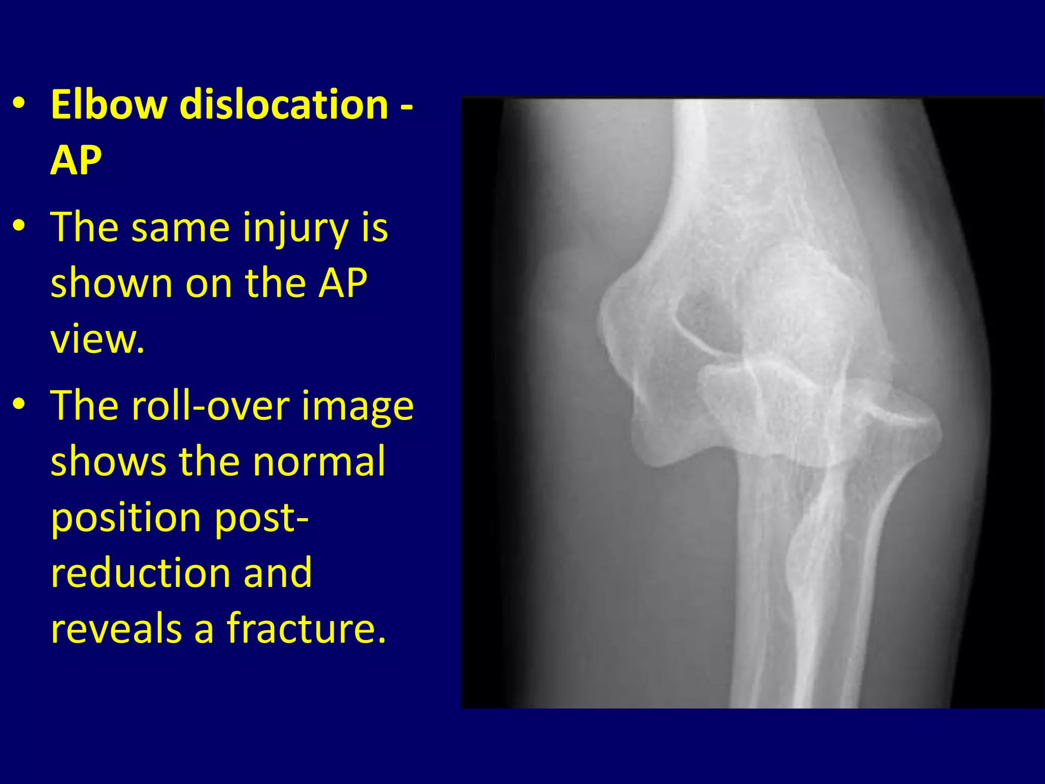 Dislocations of joint. Joint Dislocation | PPTX
