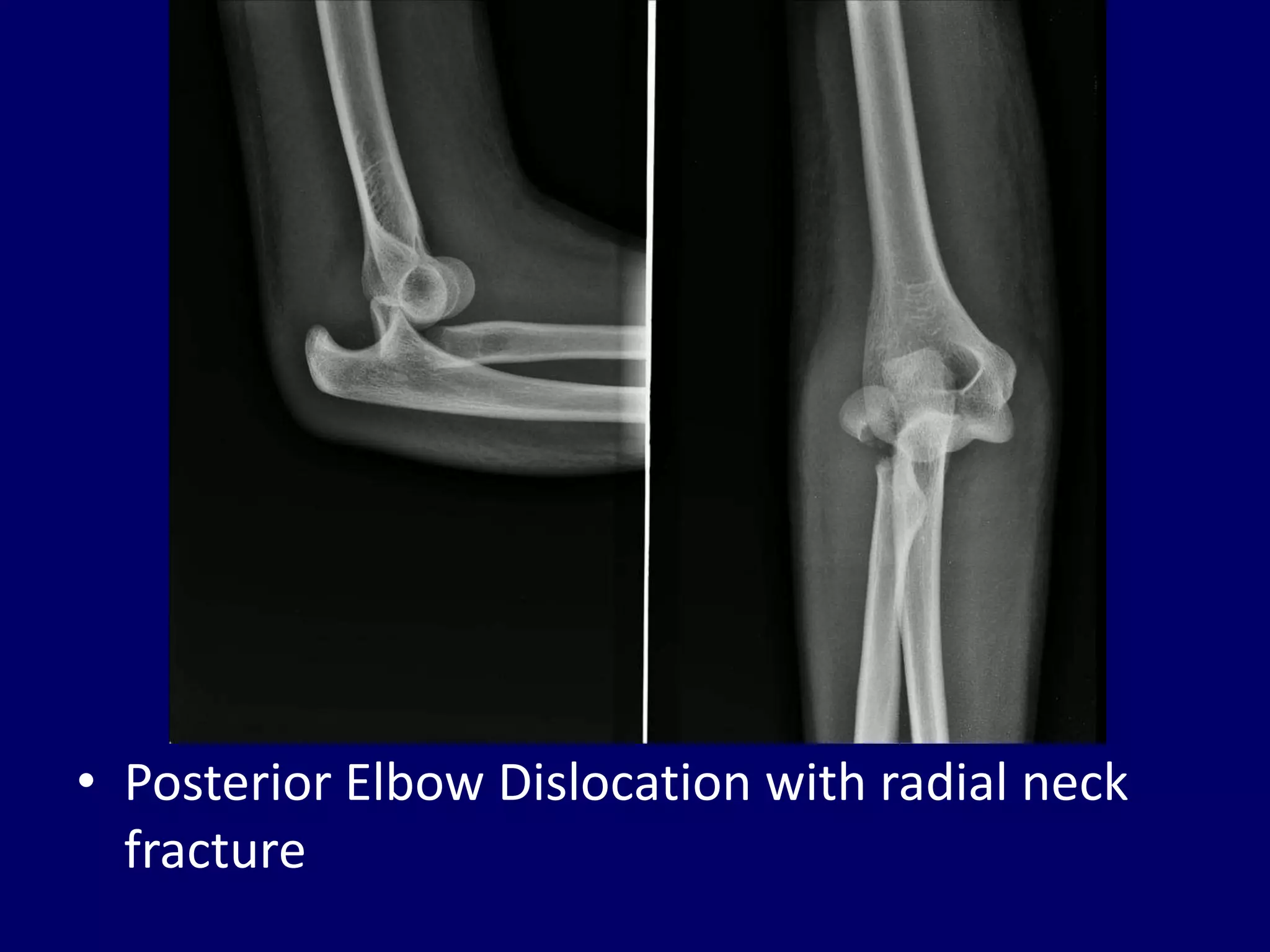 Dislocations of joint. Joint Dislocation | PPTX