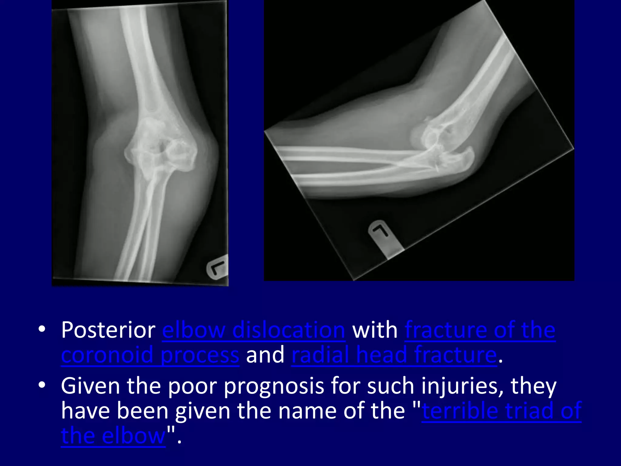 Dislocations of joint. Joint Dislocation | PPTX