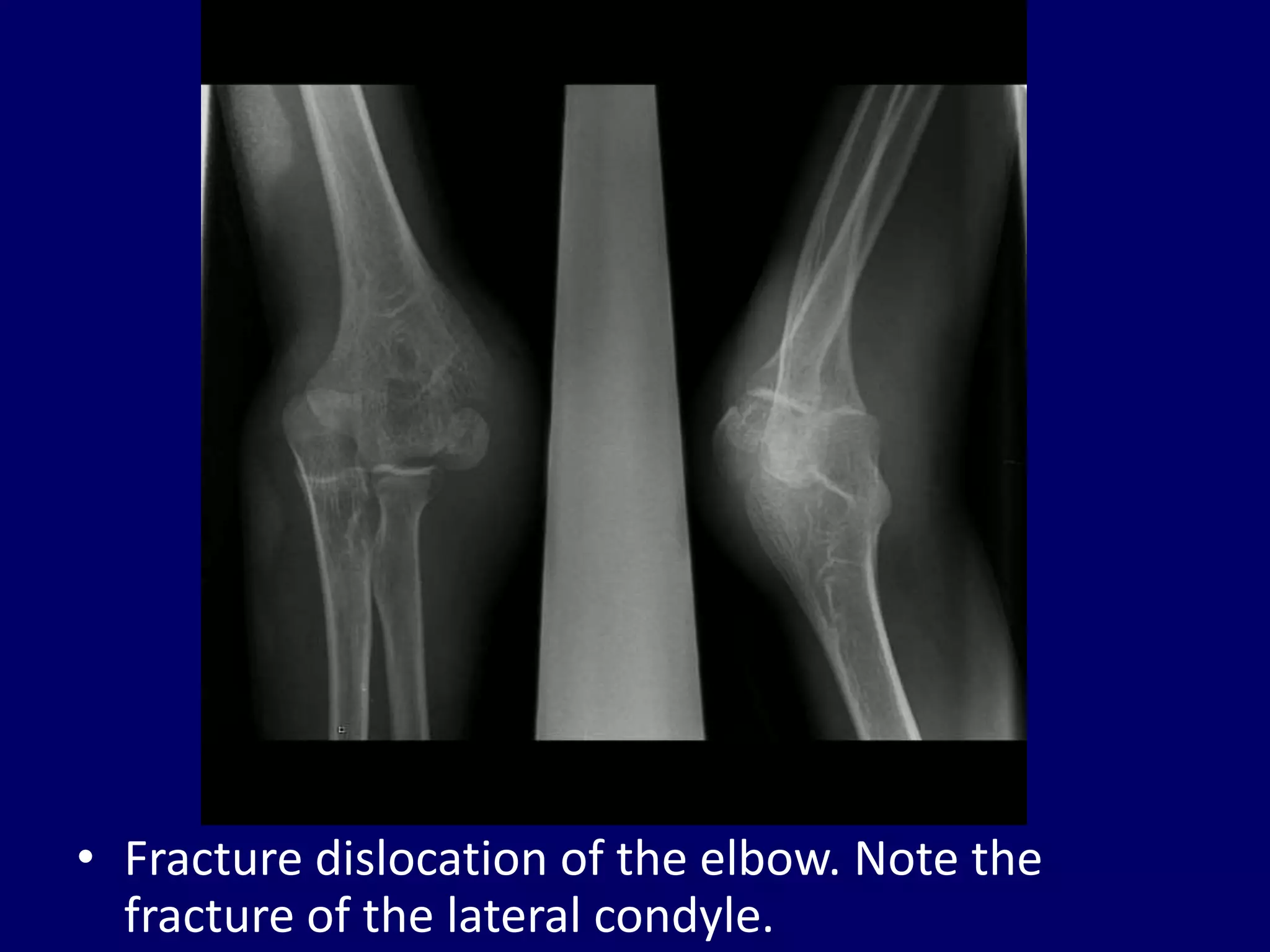 Dislocations of joint. Joint Dislocation | PPTX