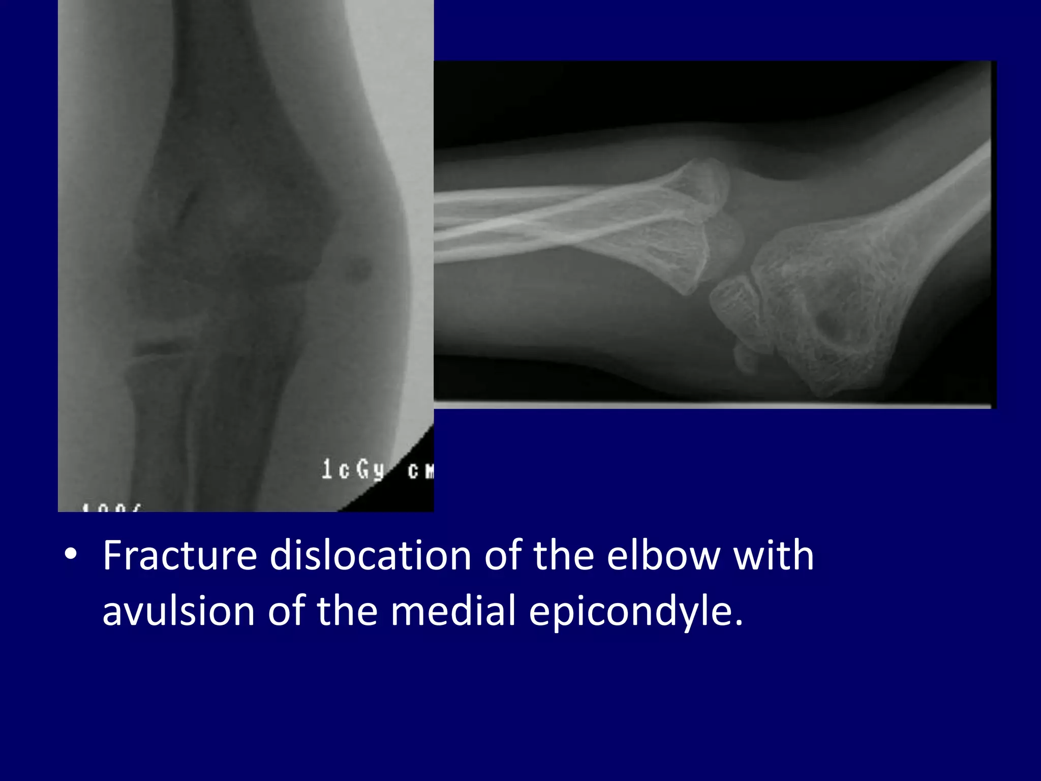 Dislocations of joint. Joint Dislocation | PPTX
