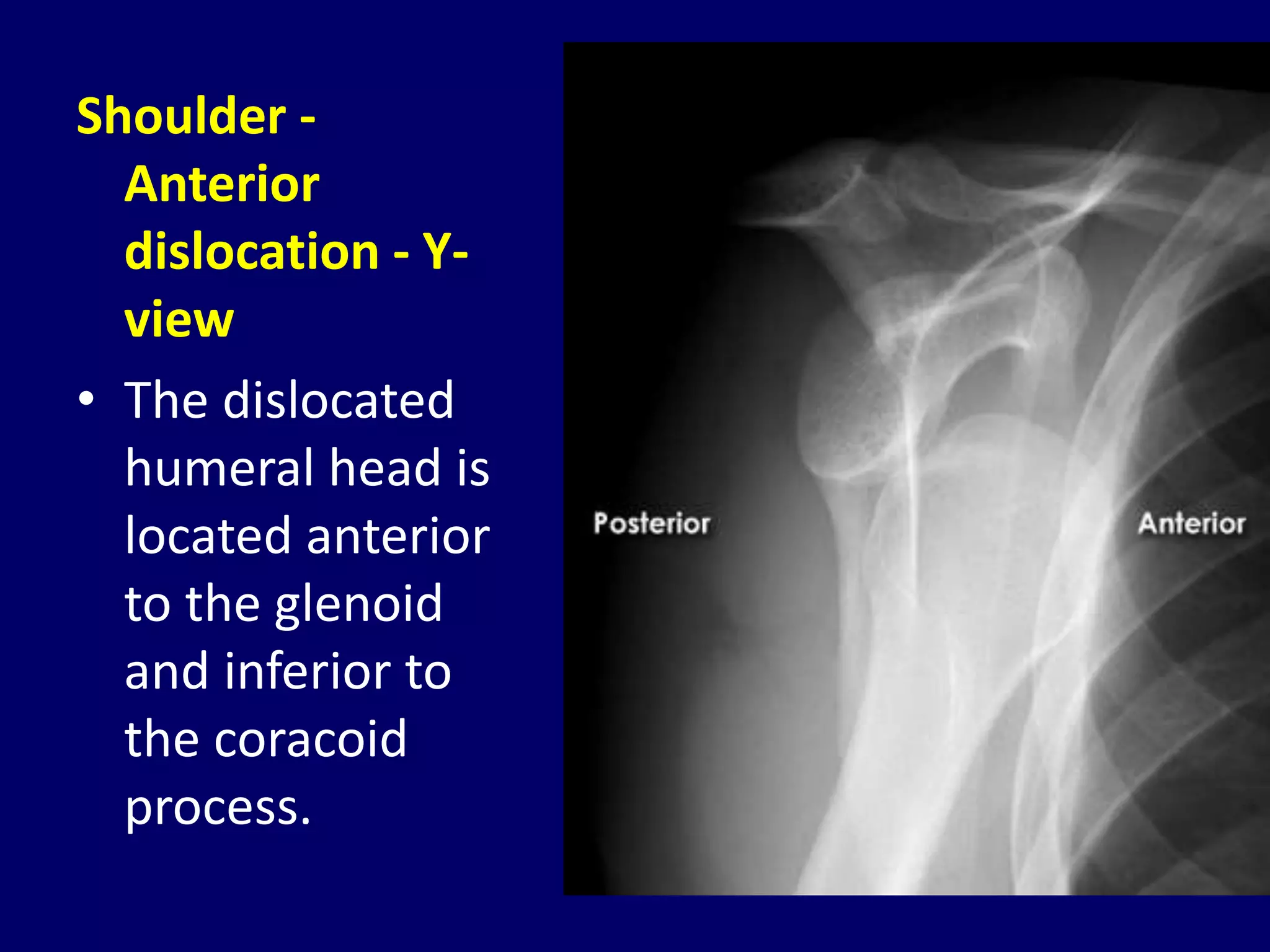 Dislocations of joint. Joint Dislocation | PPTX