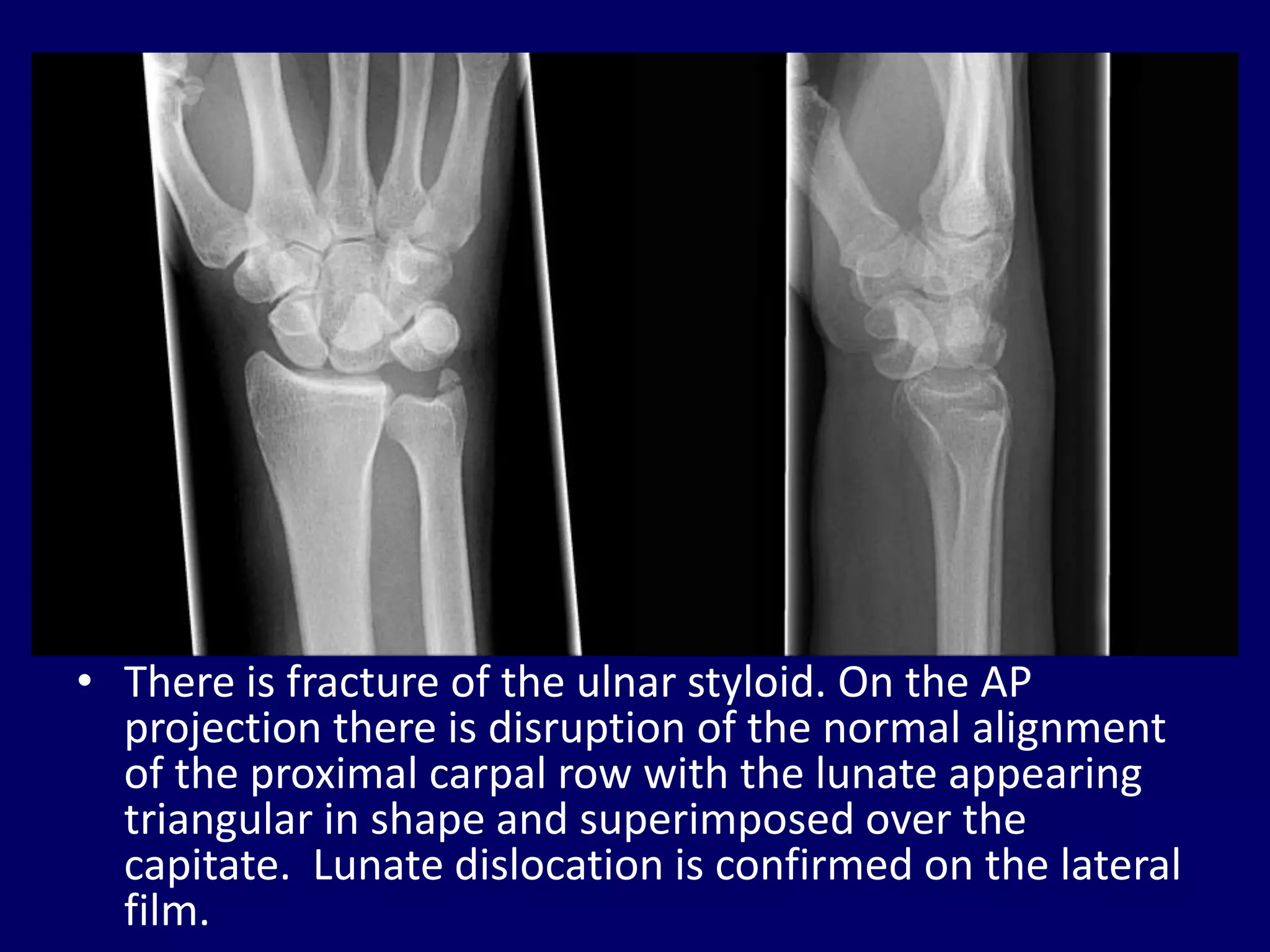 Dislocations of joint. Joint Dislocation | PPTX