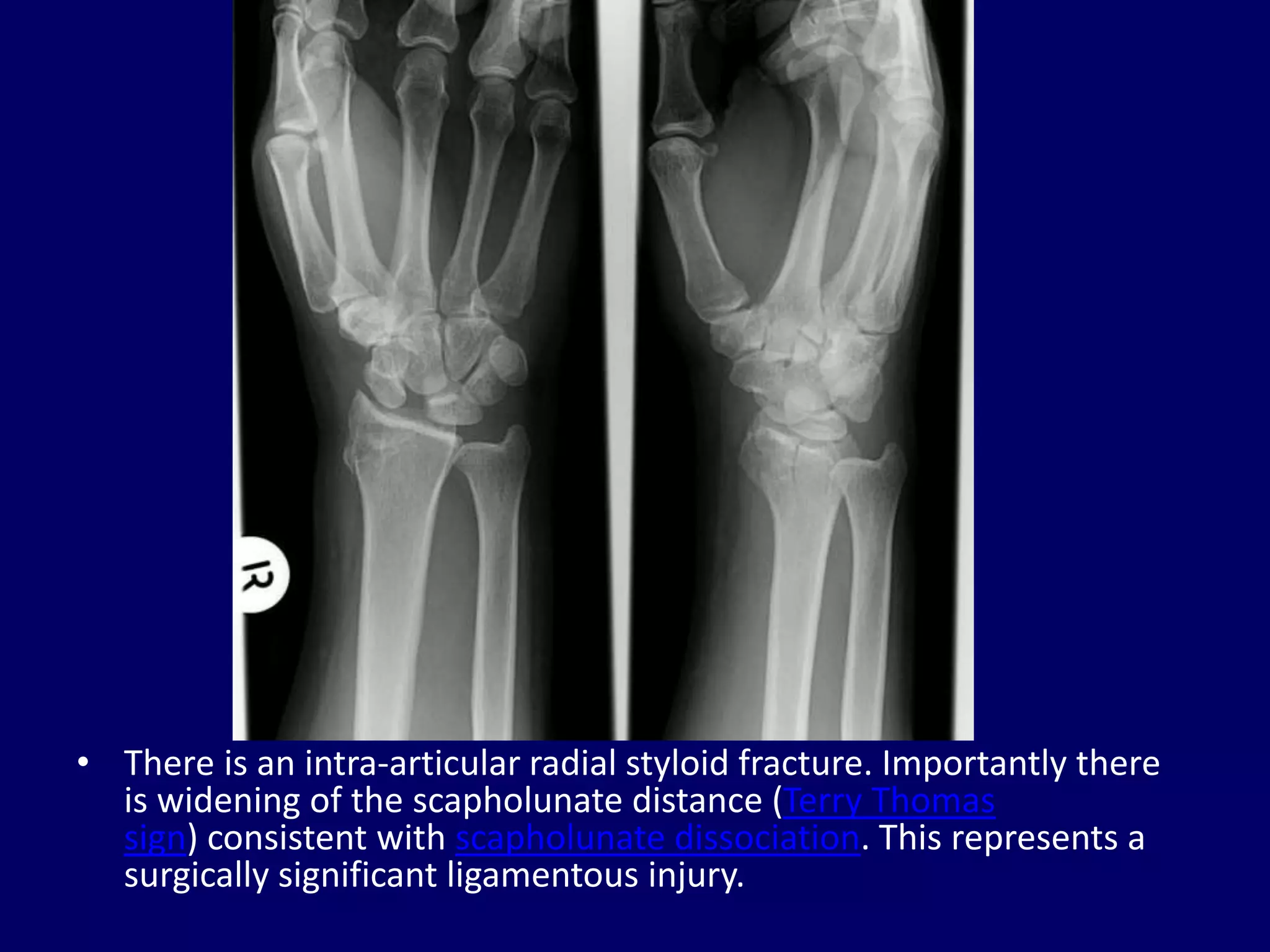 Dislocations of joint. Joint Dislocation | PPTX