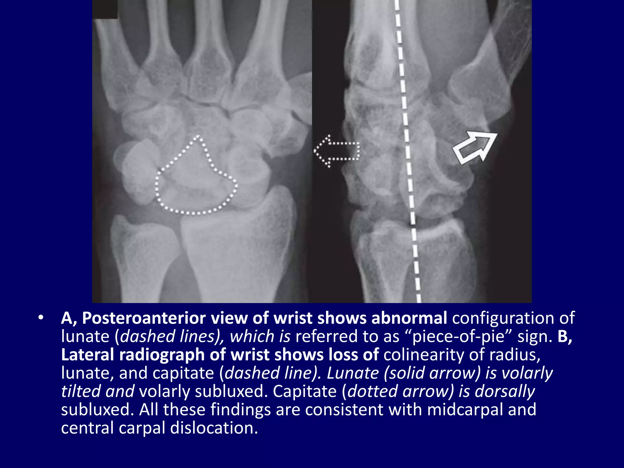 Dislocations of joint. Joint Dislocation | PPTX