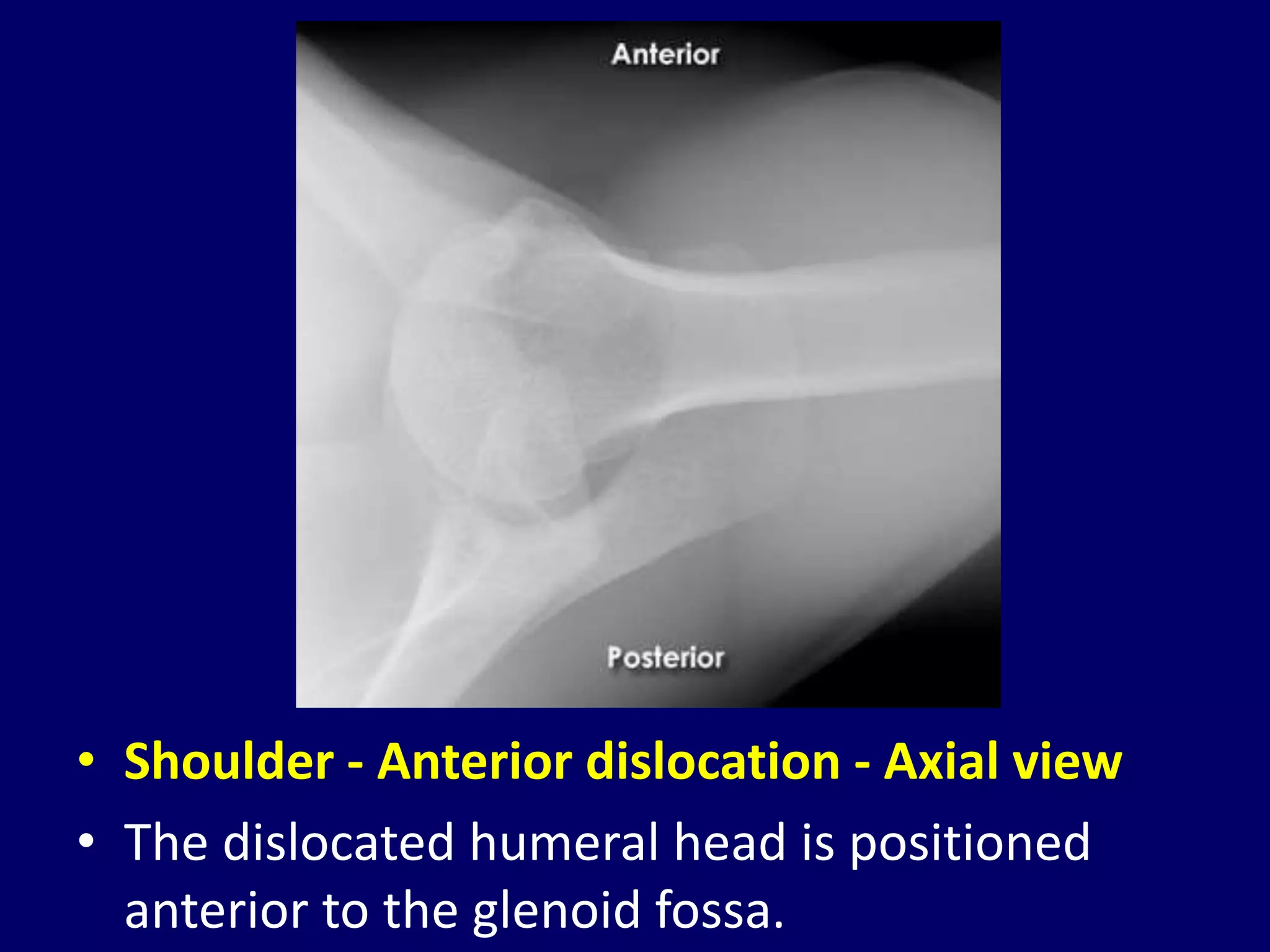 Dislocations of joint. Joint Dislocation | PPTX
