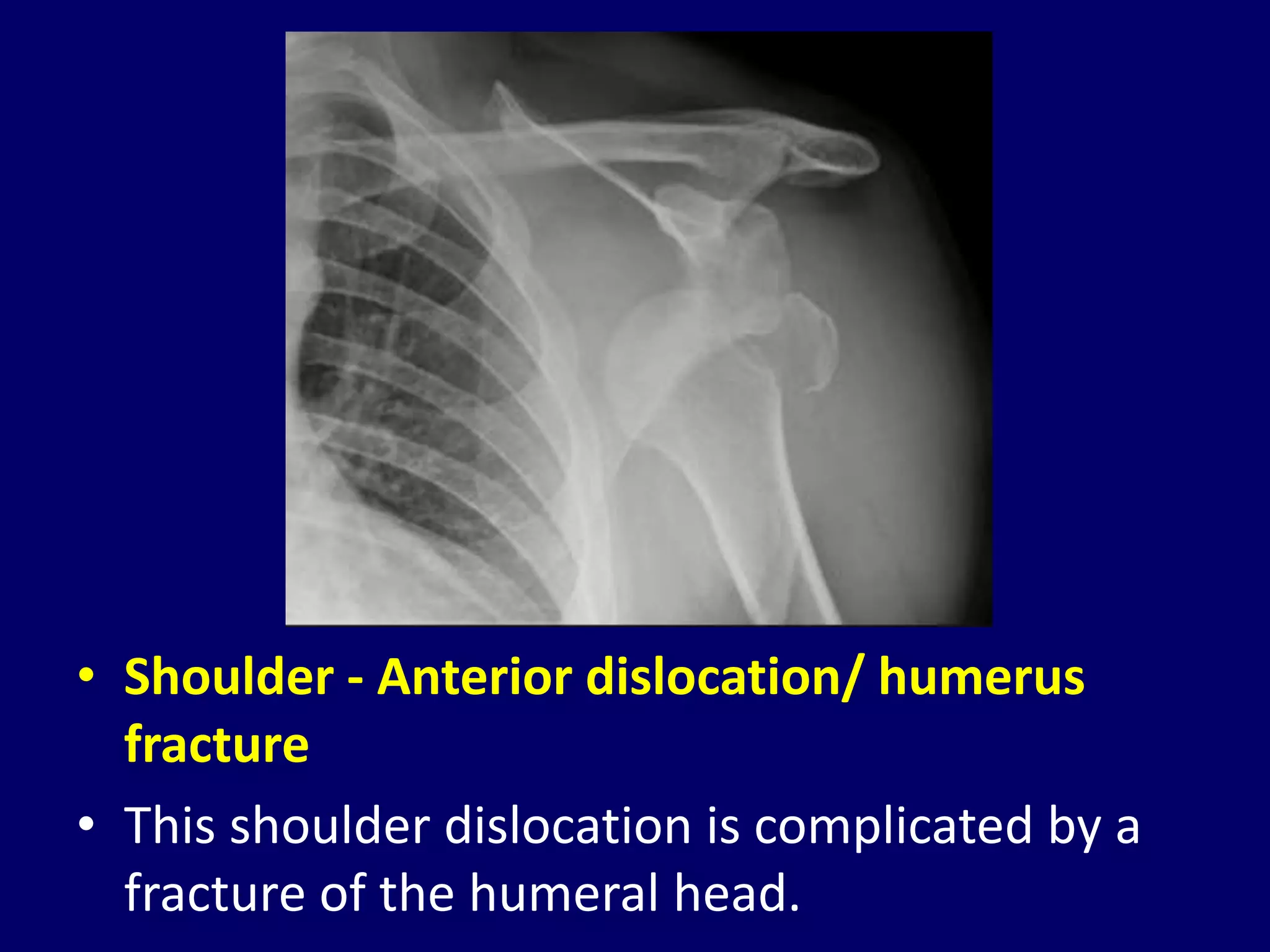Dislocations of joint. Joint Dislocation | PPTX