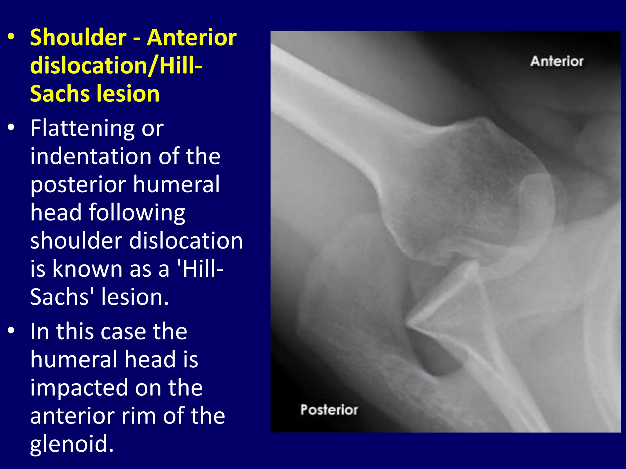 Dislocations of joint. Joint Dislocation | PPTX