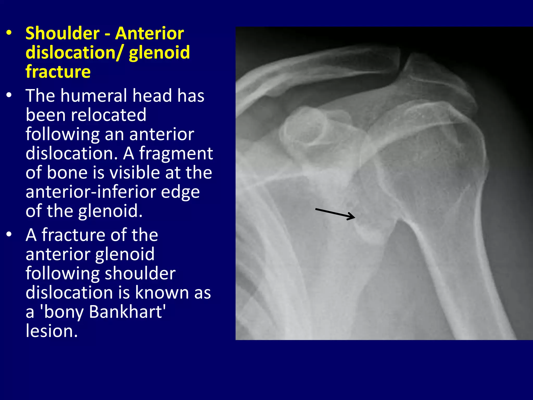 Dislocations of joint. Joint Dislocation | PPTX
