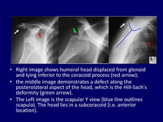 Dislocations of joint. Joint Dislocation | PPTX