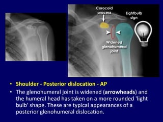 Dislocations of joint. Joint Dislocation | PPTX