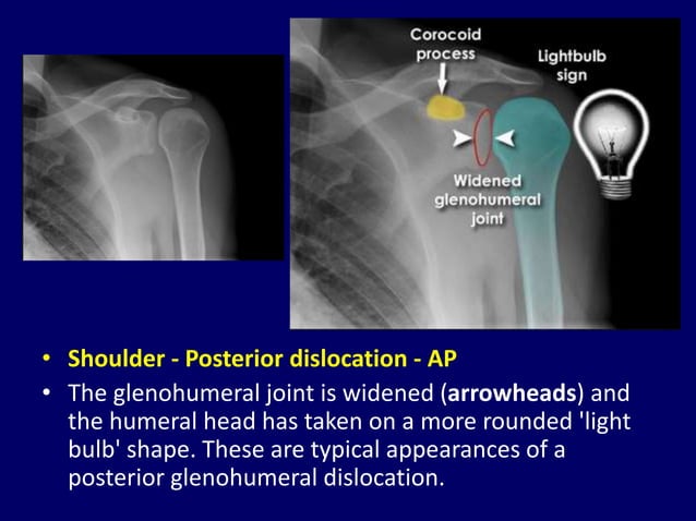 Dislocations of joint. Joint Dislocation | PPTX | Death, Injury, or ...