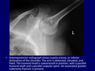 Dislocations of joint. Joint Dislocation | PPTX