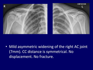 Dislocations of joint. Joint Dislocation | PPTX