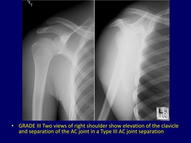 Dislocations of joint. Joint Dislocation | PPTX | Death, Injury, or ...