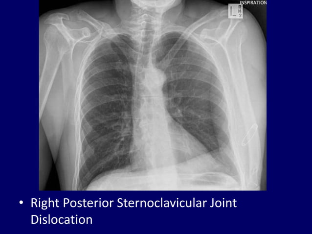 Dislocations of joint. Joint Dislocation | PPTX | Death, Injury, or ...