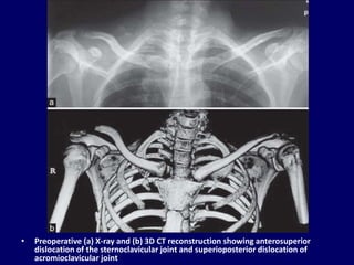 Dislocations of joint. Joint Dislocation | PPTX