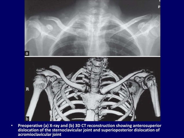 Dislocations of joint. Joint Dislocation | PPTX | Death, Injury, or ...