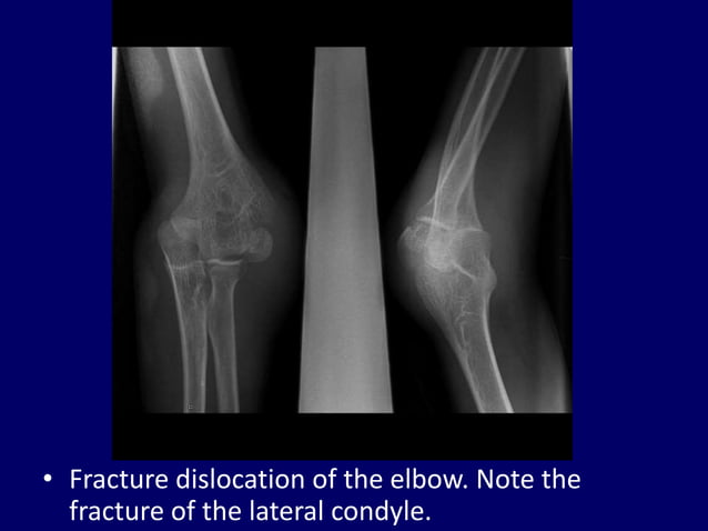 Dislocations of joint. Joint Dislocation | PPTX | Death, Injury, or ...