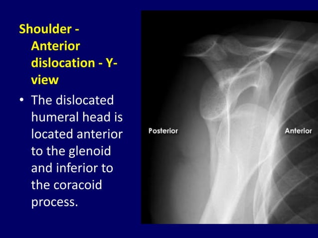 Dislocations of joint. Joint Dislocation | PPTX | Death, Injury, or ...
