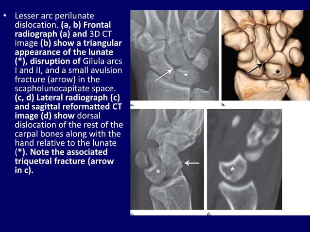 Dislocations of joint. Joint Dislocation | PPTX | Death, Injury, or ...