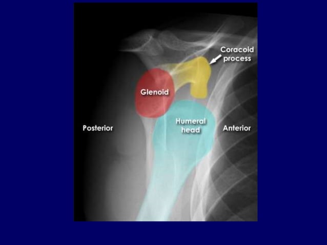 Dislocations of joint. Joint Dislocation | PPTX | Death, Injury, or ...