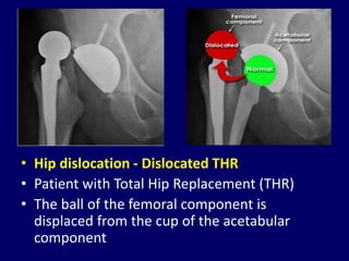 Dislocations of joint. Joint Dislocation | PPTX