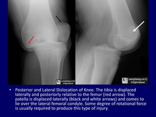 Dislocations of joint. Joint Dislocation | PPTX