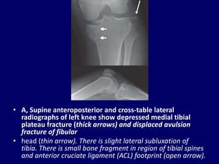 Dislocations of joint. Joint Dislocation | PPTX