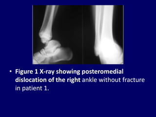 Dislocations of joint. Joint Dislocation | PPTX