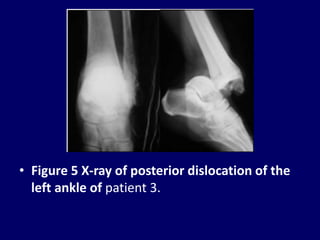 Dislocations of joint. Joint Dislocation | PPTX