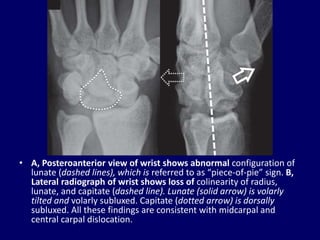 Lunate Dislocation Pie Sign