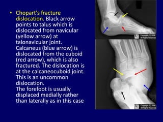Calcaneocuboid Dislocation
