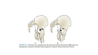 Dislokasi Panggul.pptx