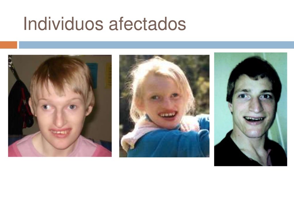 Disomía uniparental